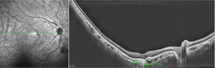 Analysis of clinical features and SS-OCT findings in patients with ...