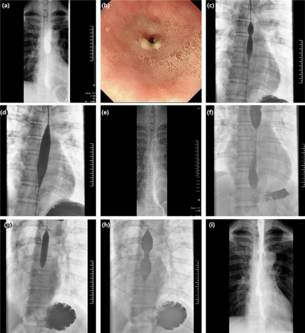 Esophageal Stricture Dilation