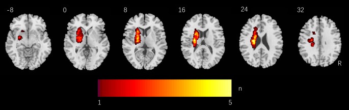 Alterations of static and dynamic changes in intrinsic brain activity and its relation to ...