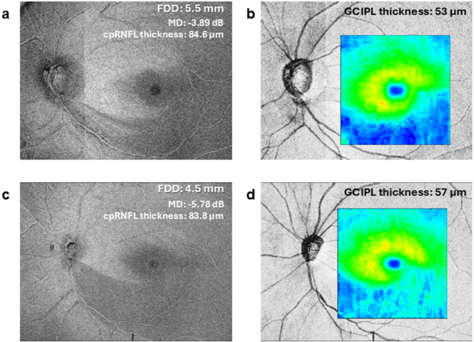 Relationships between distance from the fovea to the disc and macular ...