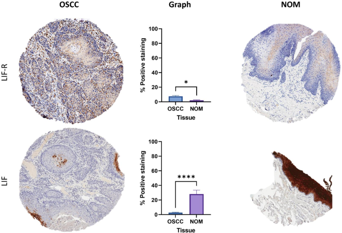 Immunohistochemical expression pattern of leukemia inhibitory factor ...