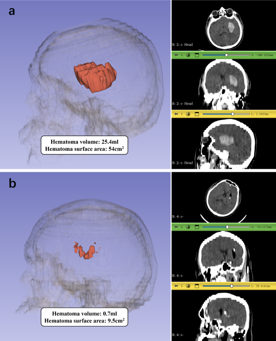 Robot assisted stereotactic surgery improves hematoma evacuation in ...
