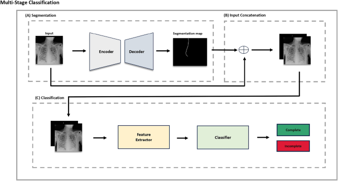 Deep learning based dual stage model for accurate nasogastric tube ...