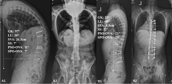 Radiologic and clinical outcomes of combining pedicle subtraction ...