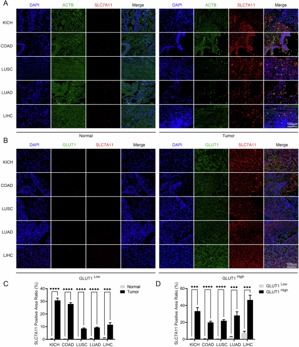 Pan-cancer analysis uncovered the prognostic and therapeutic value of disulfidptosis | npj ...