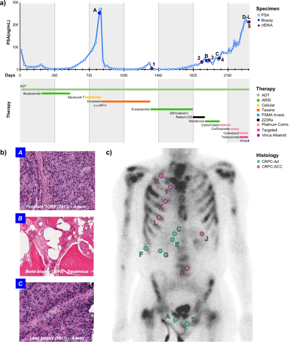 A complex phylogeny of lineage plasticity in metastatic castration ...