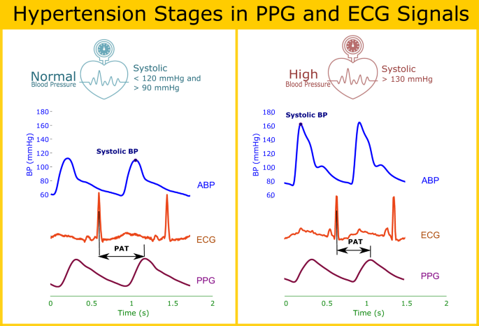 The use of photoplethysmography for assessing hypertension | npj ...