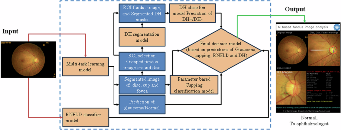 A hybrid multi model artificial intelligence approach for glaucoma ...
