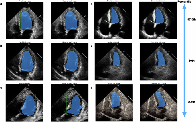 Foundation versus domain-specific models for left ventricular ...
