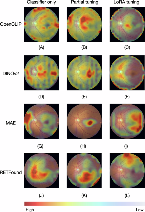 Optimizing retinal images based carotid atherosclerosis prediction with ...