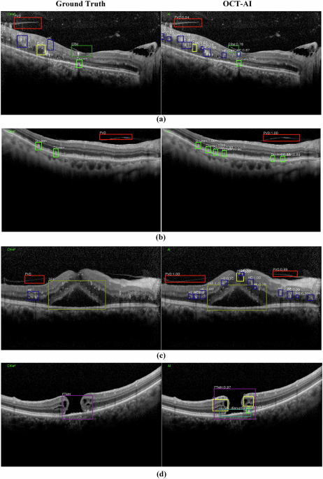 An artificial intelligence cloud platform for OCT-based retinal ...