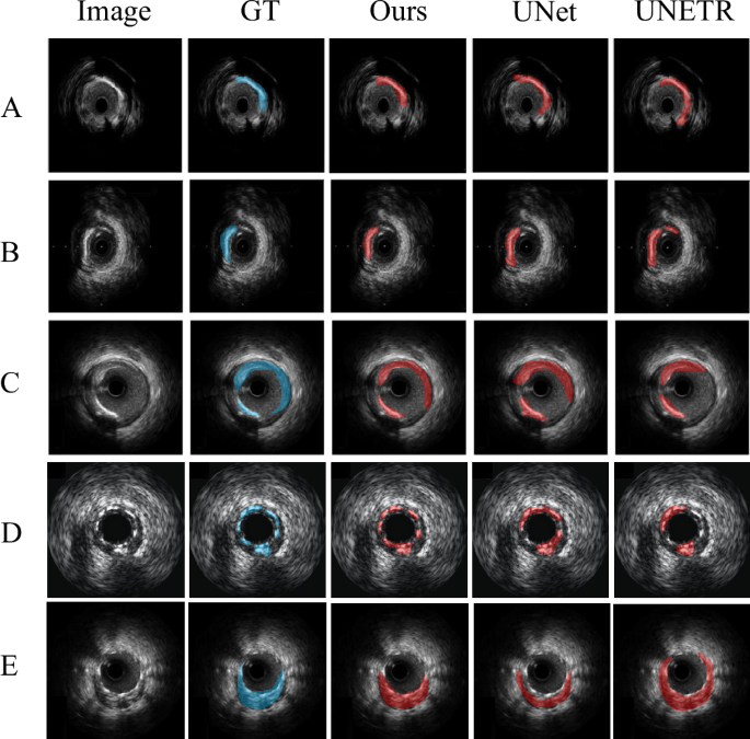 PlaqueCap: lesion-centered captioning of atherosclerotic plaques in ...