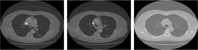 Hierarchical reasoning for lung cancer detection: from multi-scale ...
