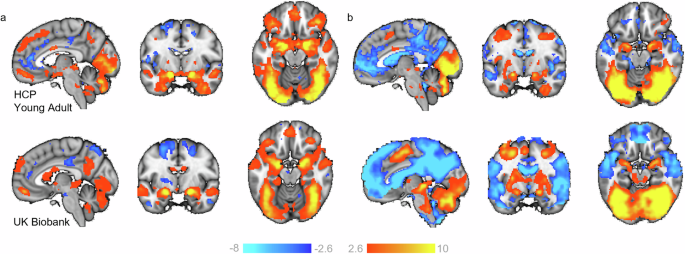 Dissecting task-based fMRI activity using normative modelling: an ...