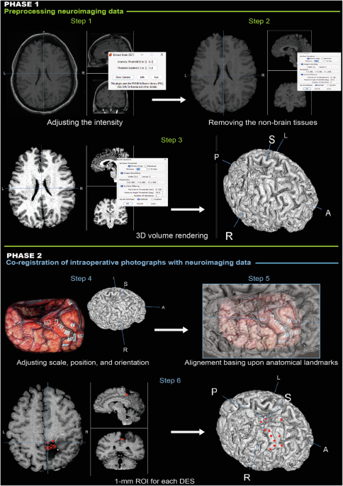 Locating eloquent sites identified during brain tumor intraoperative ...