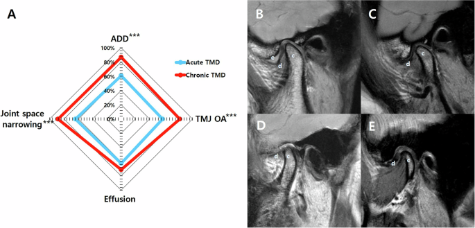 Clinical and MRI markers for acute vs chronic temporomandibular ...