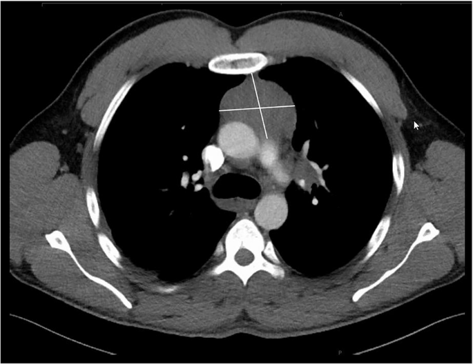 Observation of PICALM::MLLT10-rearrangement and coincidental EZH2 ...