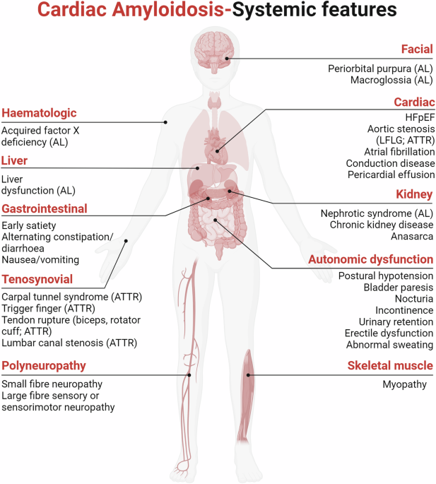 Atrial cardiomyopathy in cardiac amyloidosis: clinical imaging and ...