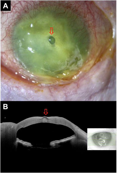 Evidence of pre-descemetocele and stromal remodelling in post-DSAEK ...