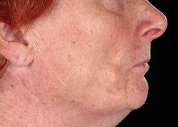 Facial atrophy following accidental subcutaneous extrusion of sodium ...