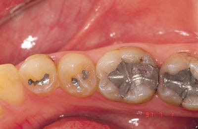 The development of resin-bonding for amalgam restorations | British ...