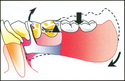 Indirect retention | British Dental Journal