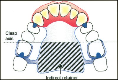 Indirect retention | British Dental Journal