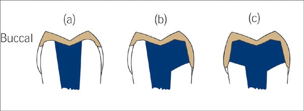 Crowns and extra-coronal restorations: Endodontic considerations: the ...
