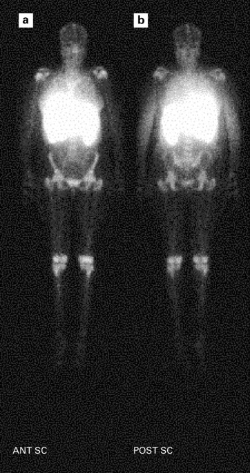 FLAG chemotherapy followed by allogeneic stem cell transplant using ...