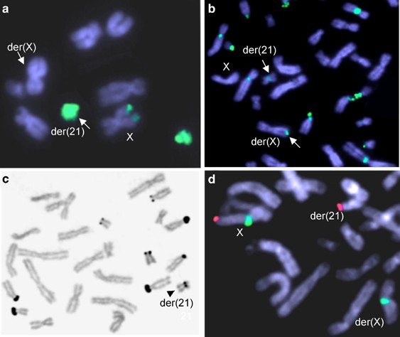 Situs ambiguus in a female fetus with balanced (X;21) translocation ...