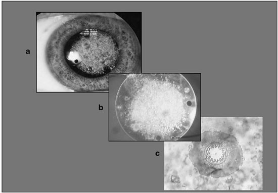 Post cataract-intraocular lens (IOL) surgery opacification | Eye