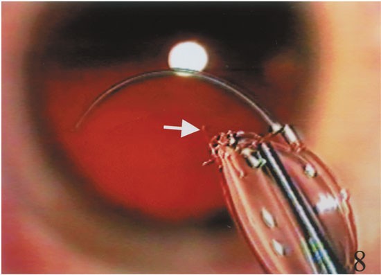 Debris on processed ophthalmic instruments: a cause for concern | Eye