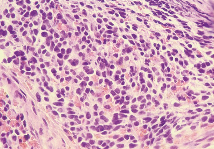 Acute visual loss as an early manifestation of metastatic neuroblastoma ...