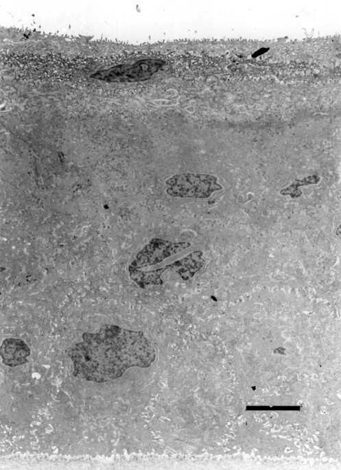 Optisol vs Dexsol as storage media for preservation of human corneal ...