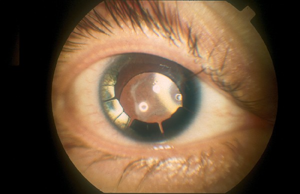 Surgical management of iris defects with prosthetic iris devices | Eye