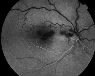 Multiple retinal haemorrhages (decompression retinopathy) following ...