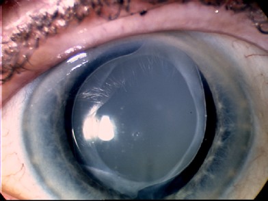 Intralenticular opacification of hydrophilic acrylic intraocular lenses ...