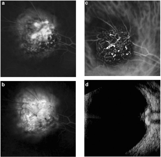Retinal astrocytic hamartoma with exudation | Eye
