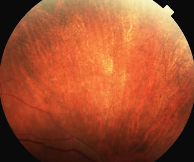 Ocular syphilis: the new epidemic | Eye