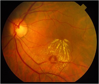 Retinal artery macroaneurysms: clinical and fluorescein angiographic ...