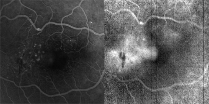 Retinal artery macroaneurysms: clinical and fluorescein angiographic ...