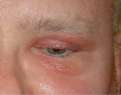 Moraxella as a cause of necrotizing fasciitis of the eyelid | Eye