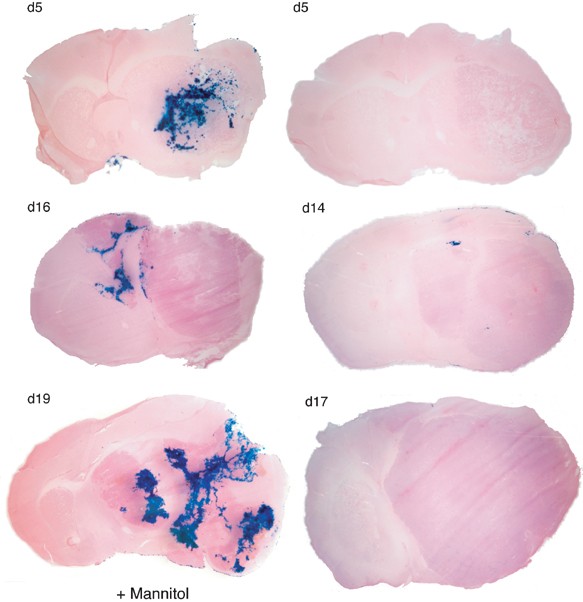 Intracarotid delivery of oncolytic HSV vector G47Δ to metastatic breast ...