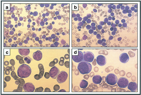 Expression profiling of B cell chronic lymphocytic leukemia suggests ...
