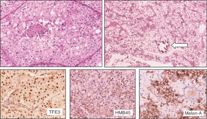 A novel CLTC-TFE3 gene fusion in pediatric renal adenocarcinoma with t ...