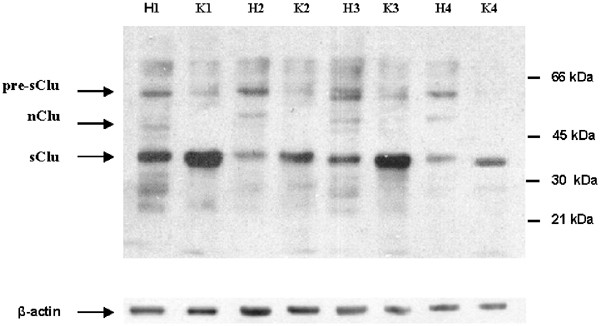 Modulation of different clusterin isoforms in human colon tumorigenesis ...