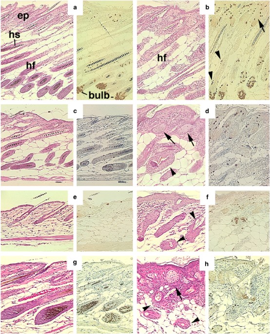 Hair follicle defects and squamous cell carcinoma formation in Smad4 ...