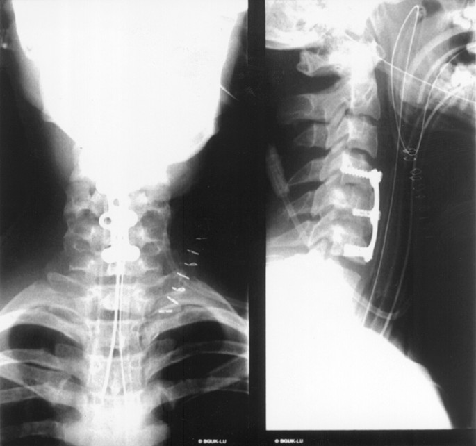Use of a free jejunal graft for oesophageal reconstruction following ...