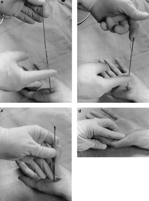 Implantation of the Freehand System ® during initial rehabilitation ...