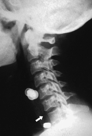 Unilateral cervical facet fracture: presentation of two cases and ...